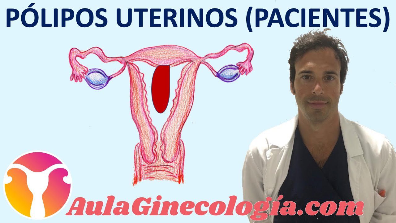 Todo lo que necesitas saber sobre la extracción de pólipos cervicales ...