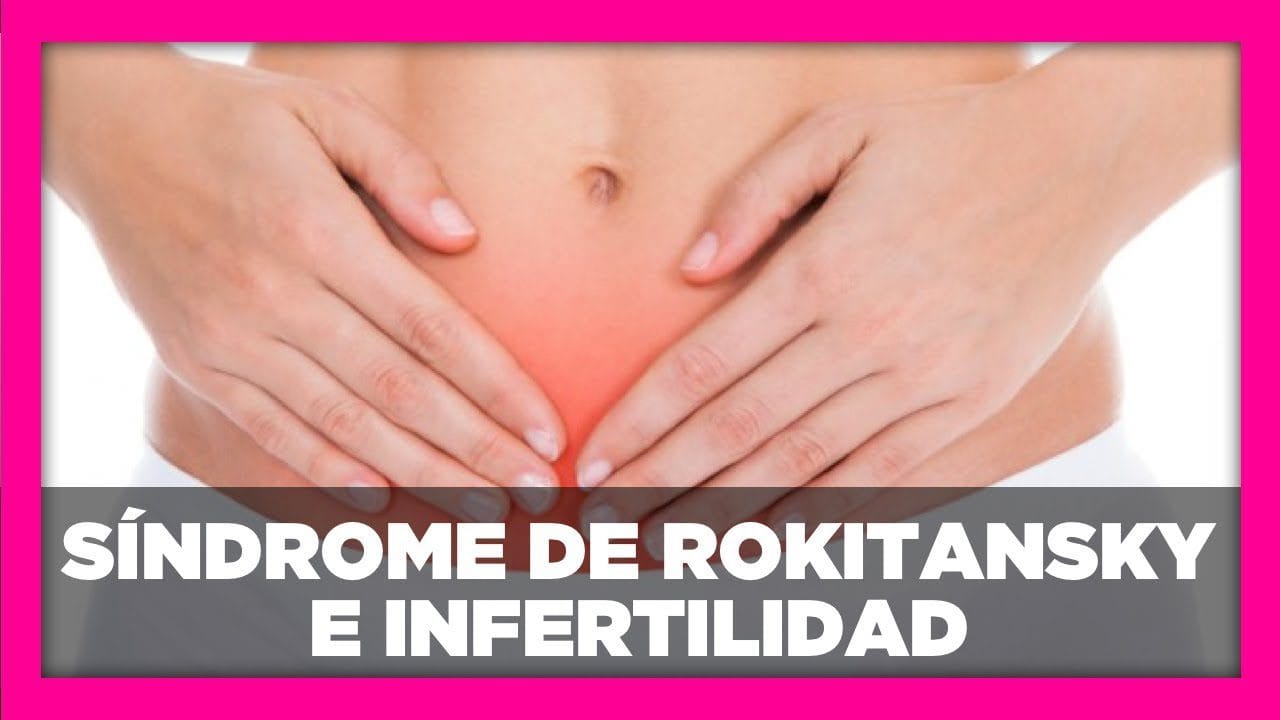 Cómo manejar el síndrome de Rokitansky: Guía completa y consejos ...